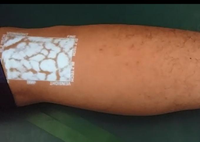 Adult Baby Vein Locating Device With Optional hands-free Mobile or ...