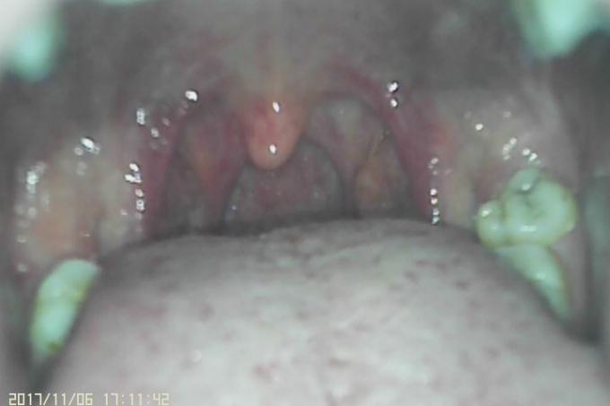 Handheld Throat Endscope Digital Laryngoscope Micro SD Card With 3.5 ...