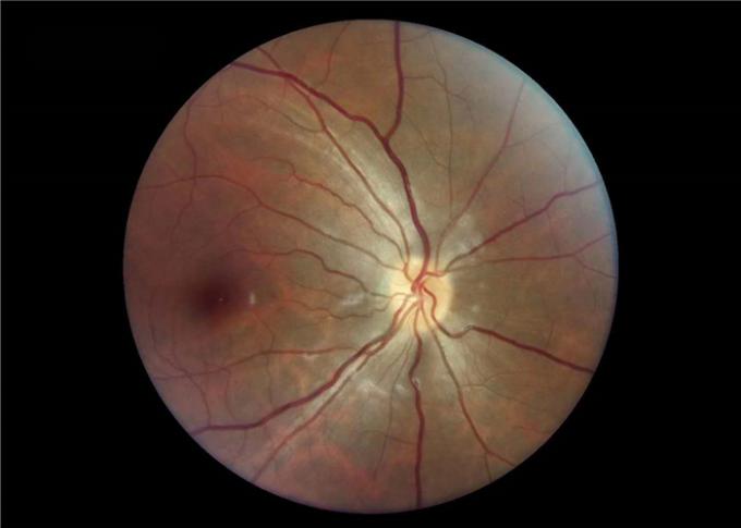 160 Million Pixel Resolution Auto Focus Ophthalmic Handheld Fundus ...