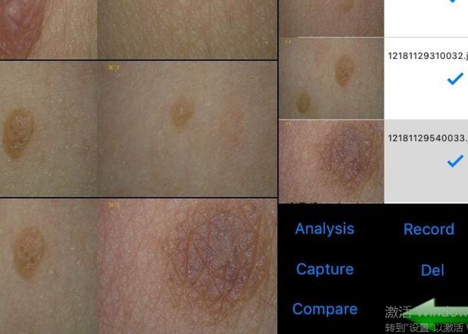 Digital Magnifier Handheld Video Dermatoscope Skin Analyzer with Data ...