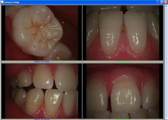 Teeth Camera Digital Video Intra Oral - scope with Two Keys Only Tooth ...