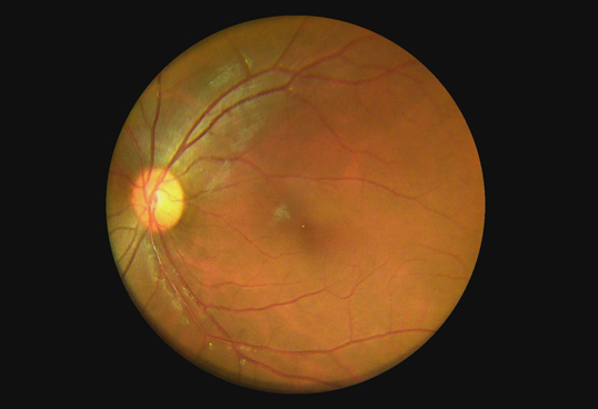 Ideal System For Telemedicine Application Portable Fundus Camera With ...