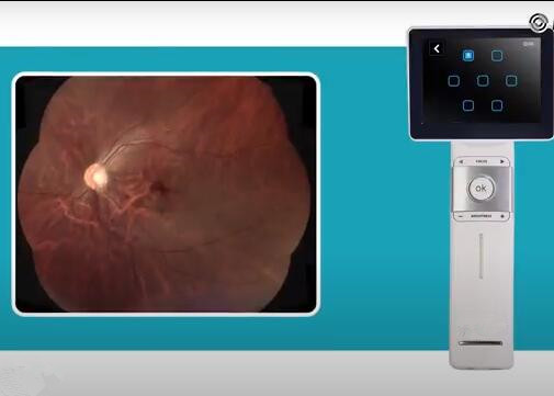 Ophthalmoscope Portable Handheld Fundus Camera Telemedicine Available ...