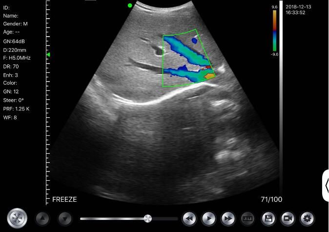 Home Doppler Ultrasound Portable Diagnostic Hand held Doppler ...