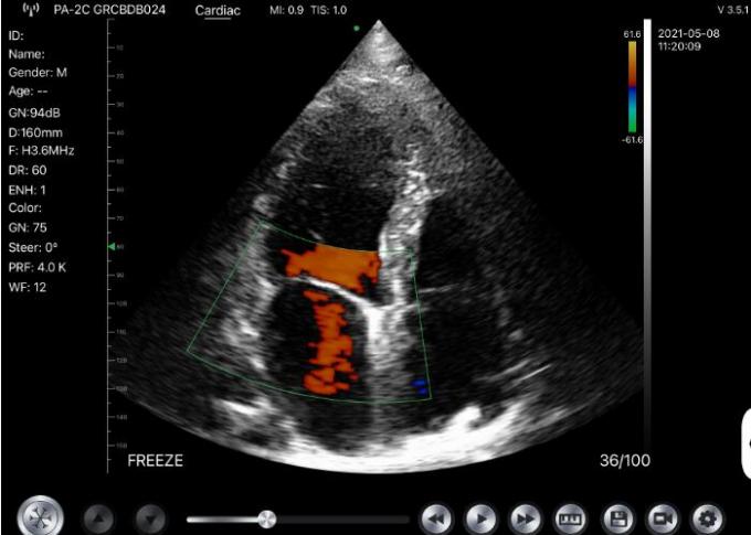 Doppler B Mode Ultrasound Scanner 2.2MHz Wireless Ultrasound Machine