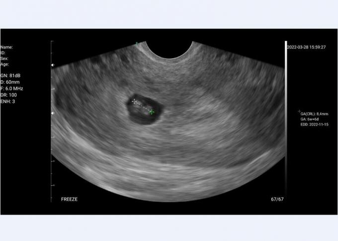 Transvaginal Endocavity Portable Pregnancy Scanner For OB / GYN ...
